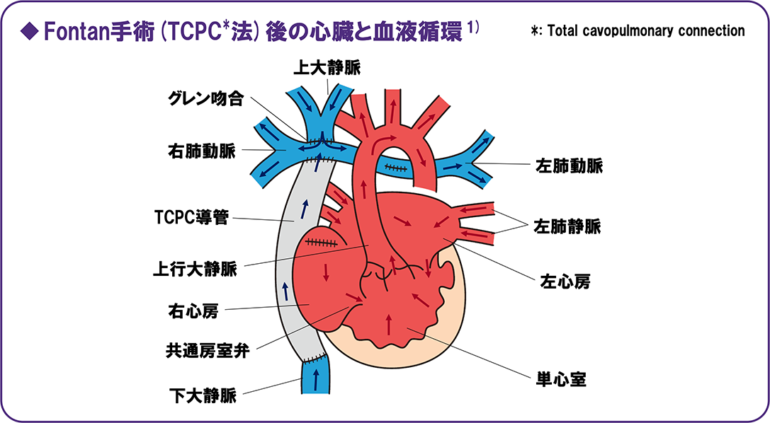 Fontan手術施行後における血栓・塞栓形成の抑制｜適応症について｜イグザレルト.jp